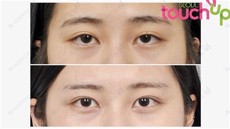 Double Eyelid Surgery Without Makeup Mugeek Vidalondon