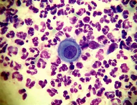 Deb Scientific Dermal Scraping Specimen Acanthocyte