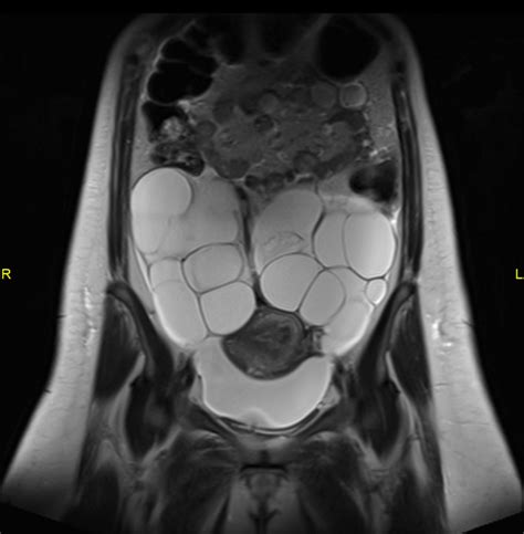 Theca Lutein Cyst