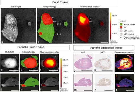 Met Receptor Targeted Fluorescent Imaging And Spectroscopy To Detect Multifocal Papillary
