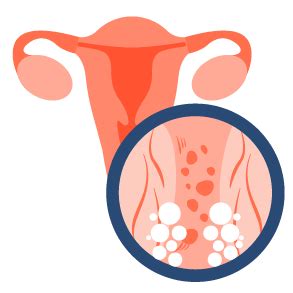 Uterine Fibroids Hello Doctor