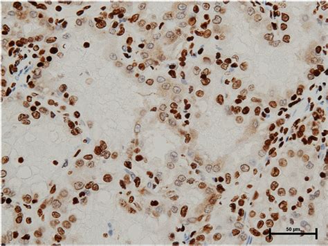 Hmgb1 And Hmgb2 Expression Patterns In Human Papillary Renal Cancers