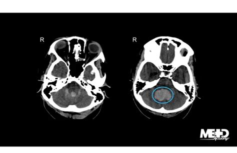 Intraventricular Hemorrhage Ct