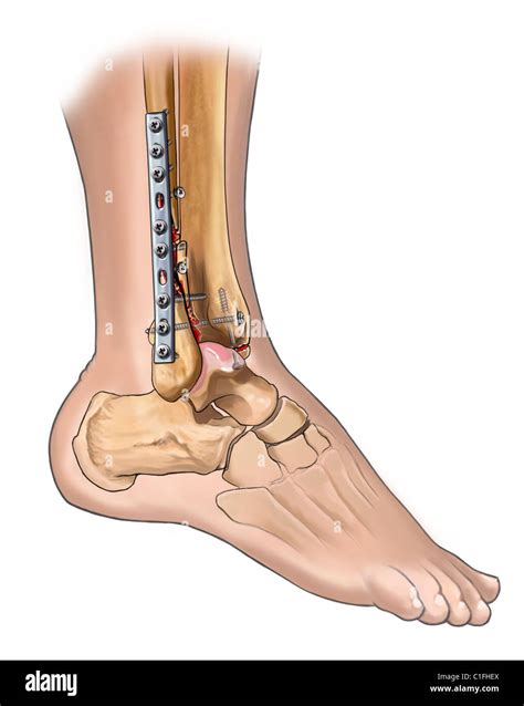 Fracture Of Tibia And Fibula High Resolution Stock Photography And Images Alamy
