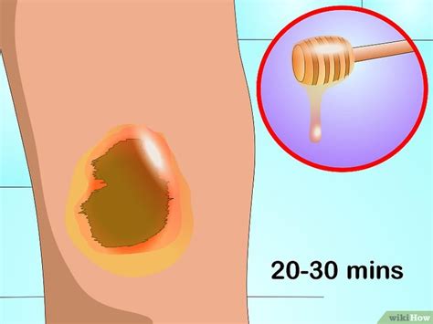 How To Get Rid Of Acne Scabs Fast 10 Effective Ways