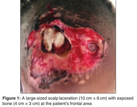 Severe Scalp Laceration In A Six Year Old Rmedicalgore