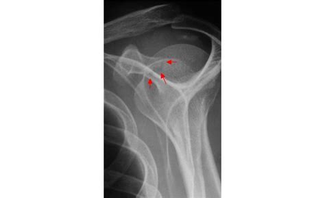 Mdk Fracture De La Coracoïde