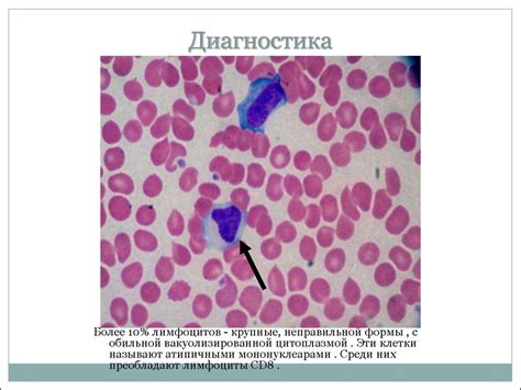 Инфекционный мононуклеоз у детей и его последствия презентация онлайн