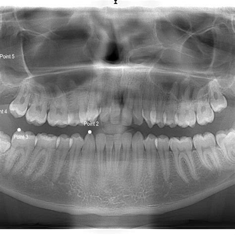 Difference Of Parameters According To Malocclusion Classes Download Scientific Diagram