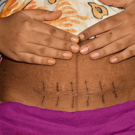 Caring For Your C Section Scar Tips And Insights For A Smooth Recovery