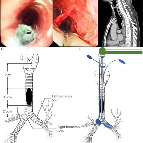 Qualitative Comparison Of Different Lung Separation Techniques For The