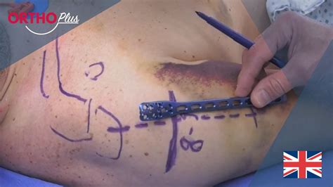 Homeral Head Fracture Orif Medplus