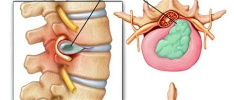 Hoe Genezing Hernia Versnellen Tips And Behandelingen