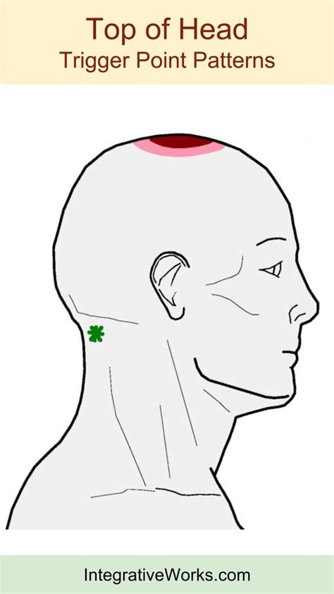 Understanding Trigger Points Headache On The Top Of Your Headintegrative Works Integrative