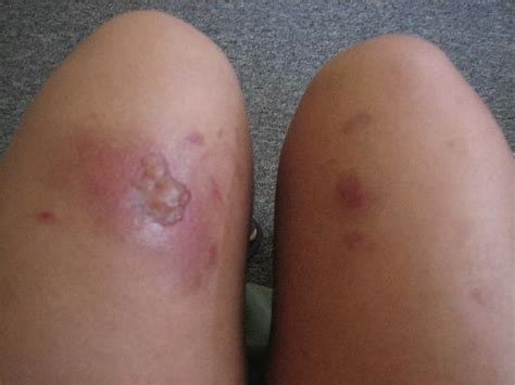 Bug Bite Vs Staph Infection