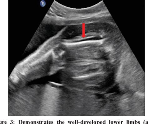 Figure 3 From Twin Reversed Arterial Perfusion Sequence In Monochorionic Diamniotic Pregnancy A