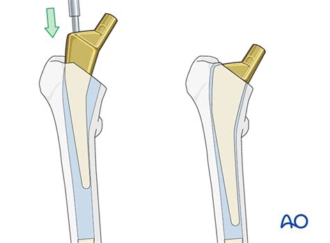 Hemiarthroplasty For Femoral Neck And Head Fractures With Hip Dislocation