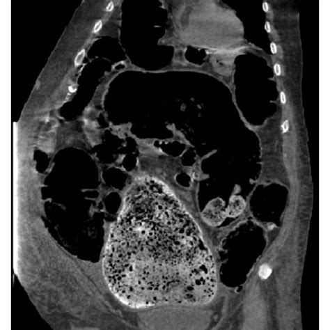 Coronal Section On A Computerized Tomography Ct Scan Showing Severe