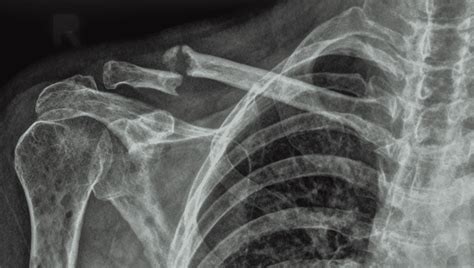 New Multiple Myeloma Therapy Sees Success In Over 70 Percent Of