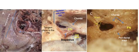 Temporal Bone Anatomy Cadaveric Dissection Iowa Head And Neck