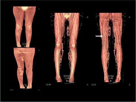 Role Of Three Dimensional Computed Tomography Venography As A Powerful