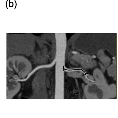 Renal Artery Reconstruction Image A Cor Mpr Left Renal Artery Angle