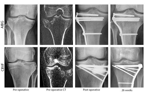 Cerament® G Bone Remodeling