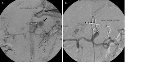 Digital Subtraction Selective Celiac Arteriogram A Pre Embolization