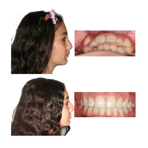 Growth Modification Dr Zaha Orthodontic And Dental Center