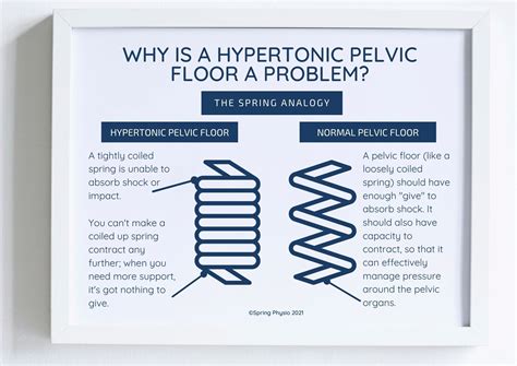 Hypertonic Pelvic Floor Pelvic Floor Art Pelvic Floor Poster Etsy