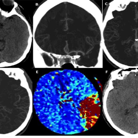 A 57 Year Old Male Presented With Left Visual Field Hemianopia And Download Scientific Diagram