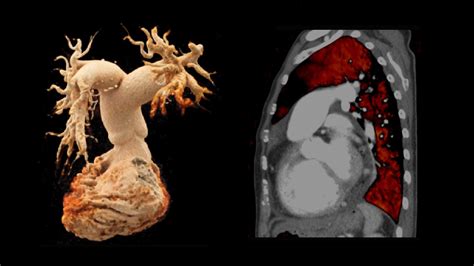 Chronic Thromboembolic Pulmonary Hypertension Siemens Healthineers