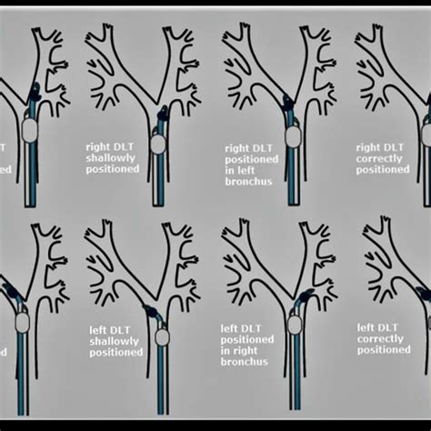 Endobronchial Blockers A Ec Blocker B Cohen Blocker C Arnd Blocker