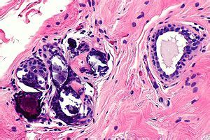 Breast Calcifications Libre Pathology