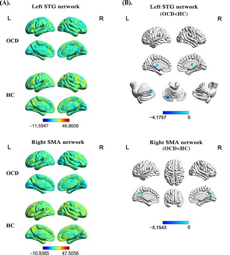 Voxel Wise Analysis Of Dfc Patterns In Abnormal Gmv Brain Regions The