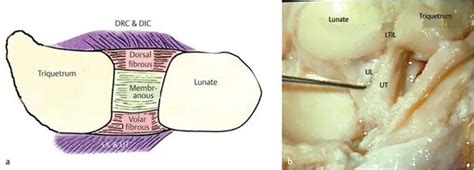 Lunotriquetral Ligament Wikism Sports Medicine Wiki