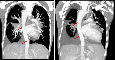 Right Sided Aortic Arch With Aberrant Left Subclavian Artery