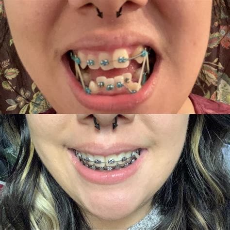 Best R Braces Images On Pholder My Teeth Change