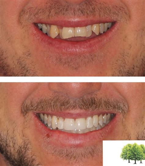Metal Braces Cardiff Birchgrove Dental Practice