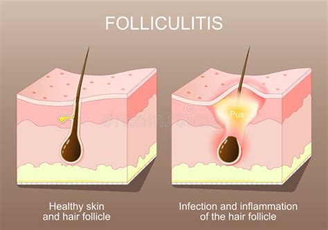 Folliculitis Healthy Skin Before And After Infection And Inflammation