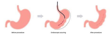 Endoscopic Ultrasound Directed Transgastric Ercp Edge Hartford Healthcare Ct