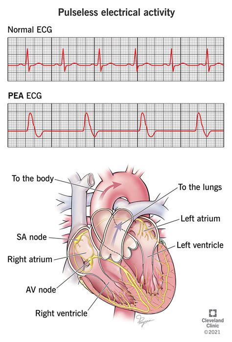 Pulseless Electrical Activity PEA Causes And Treatment