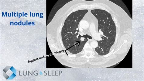 Multiple Pulmonary Nodules Are They Cancer Lung And Sleep