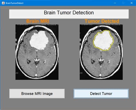 GitHub Surajmane Brain Tumor Detection