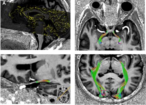 Medial Geniculate Nucleus Mri