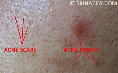 A What S The Difference Between Acne Scars And Acne Marks Skinacea Com