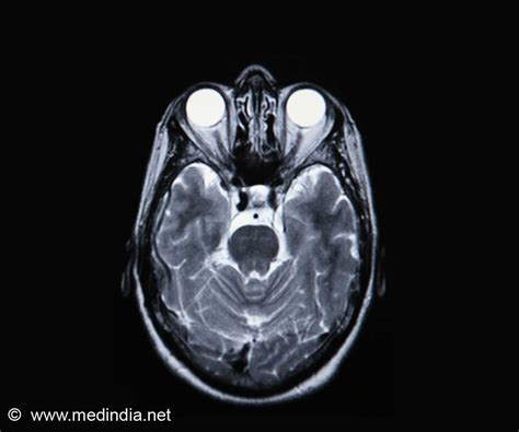 Advanced Mri Scans Reveal Hidden Concussion Risks In Patients