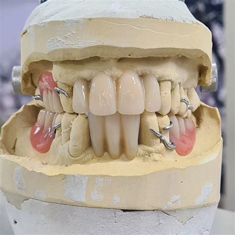 Partial Dentures In Bendigo Digital Denture Centre