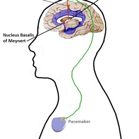 diagrammatic sketch of deep brain stimulation dbs is a fairly