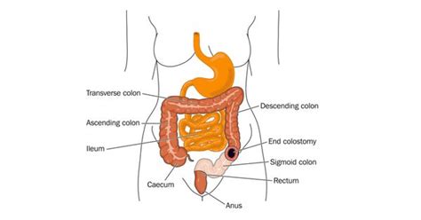 End Transverse Colostomy